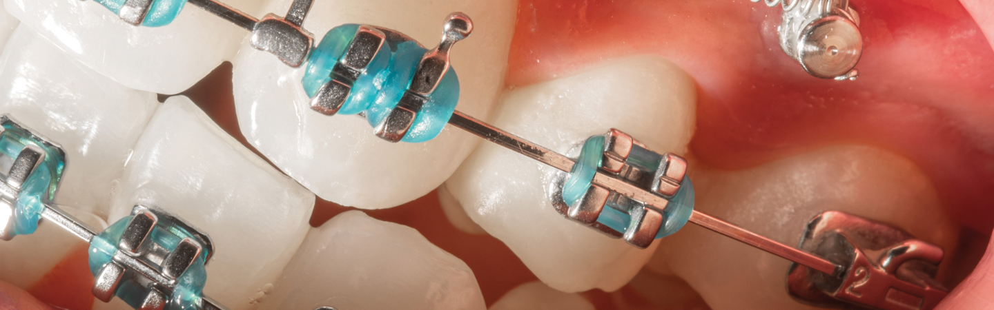 ‘Quick’ Orthodontic Systems – Risks, Benefits and Consent - iLearn