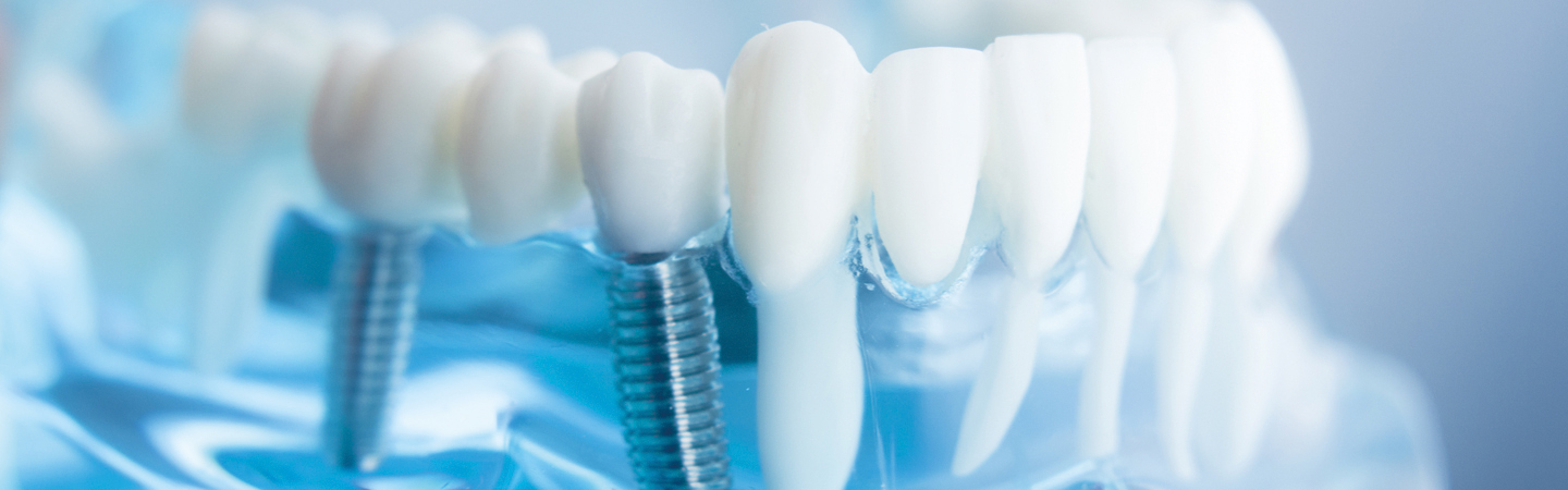 How Can We Minimise the Risk of Peri - Implant Disease? A Practical Guide for Supporting Implant ...