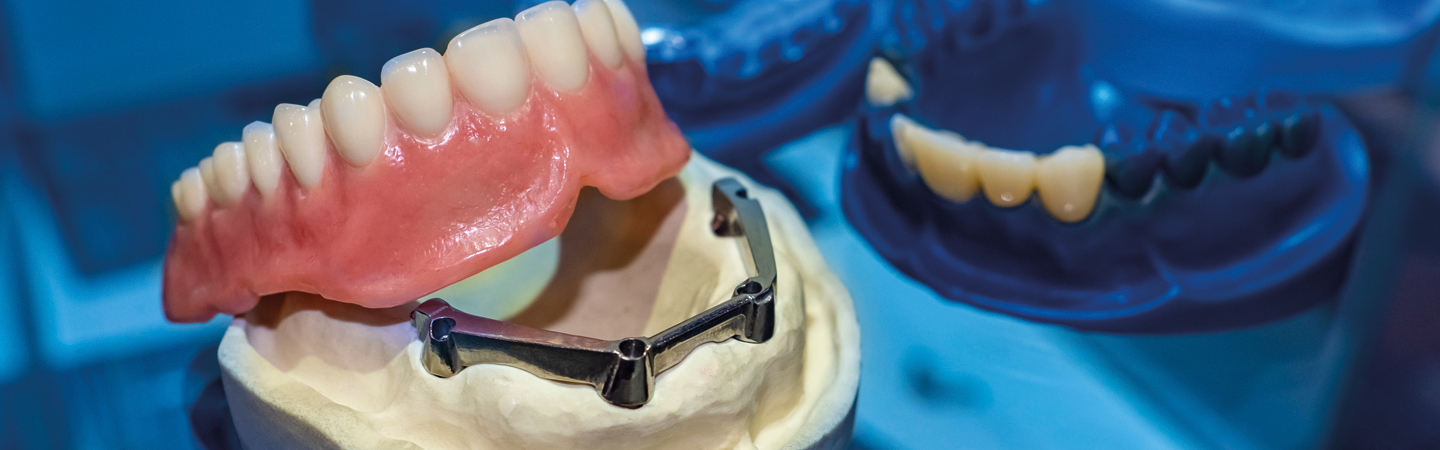 Prosthodontically Driven Tissue Supported Surgical Guides for Full Arch ...